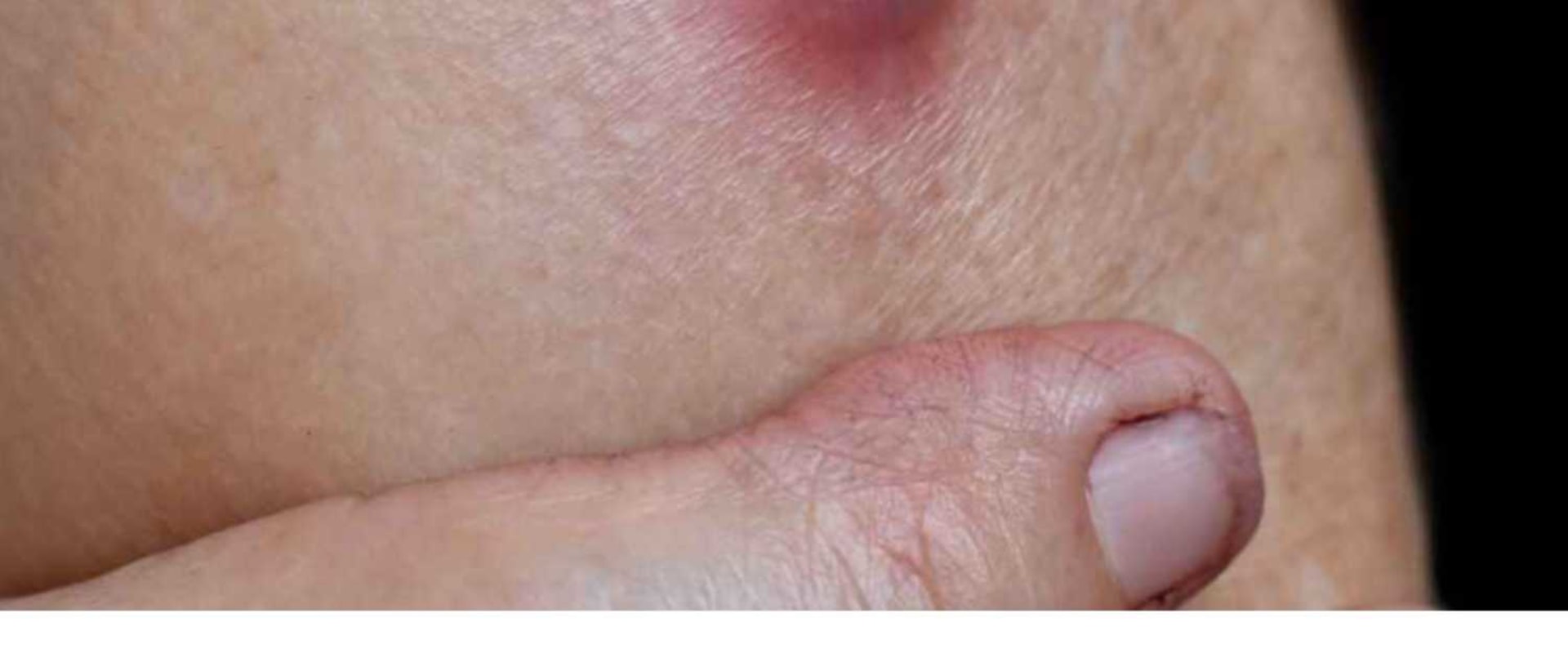 Boil vs Cyst vs Abscess: Signs, Risks & Safe Treatments