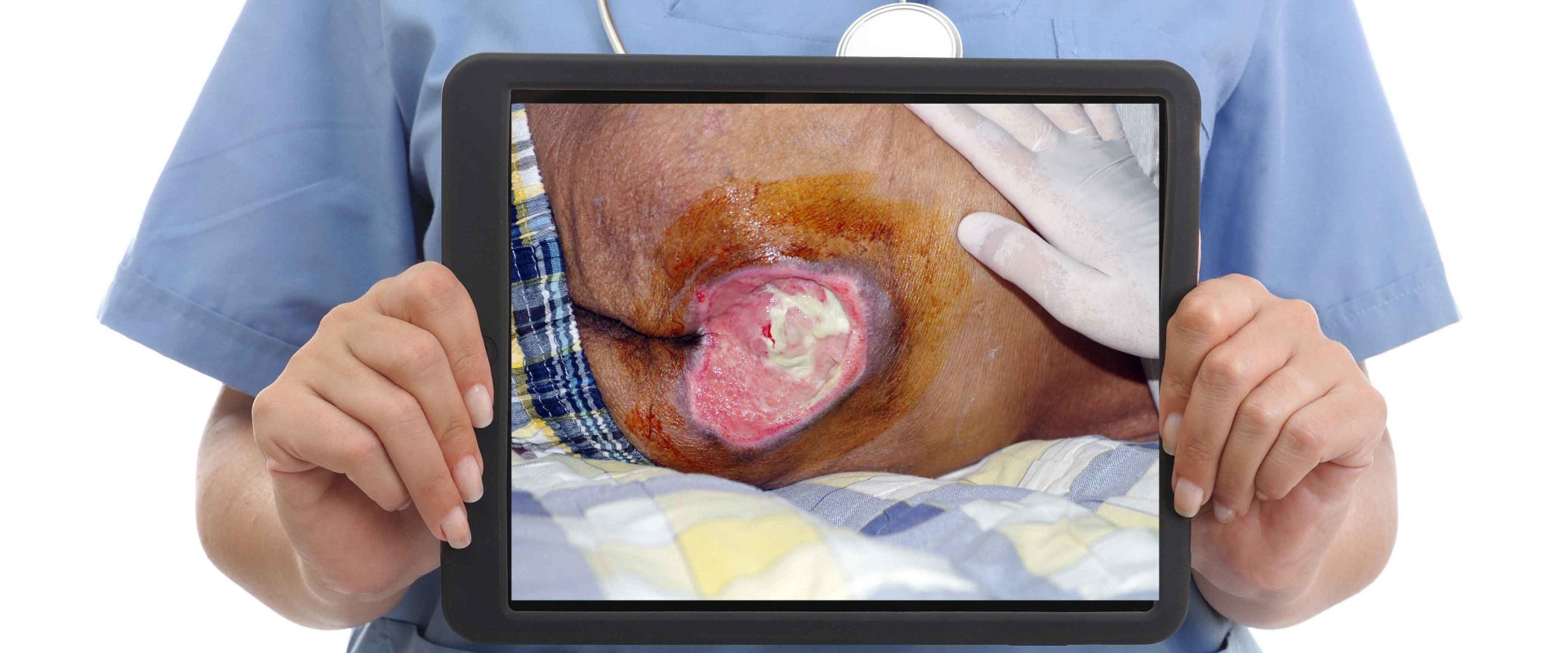 Granulation Tissue Pictures: Understanding Wound Healing Stages, Signs ...