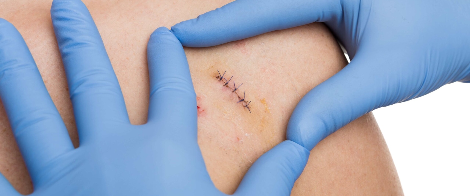 Wound Assessment and the Healing Stages for Surgical Wounds, Scars, and ...