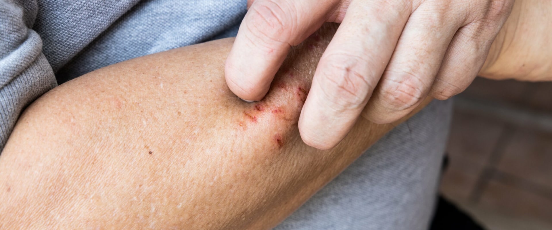 Is Itching a Sign of Healing? Know the Facts About Why Your Skin Itches ...
