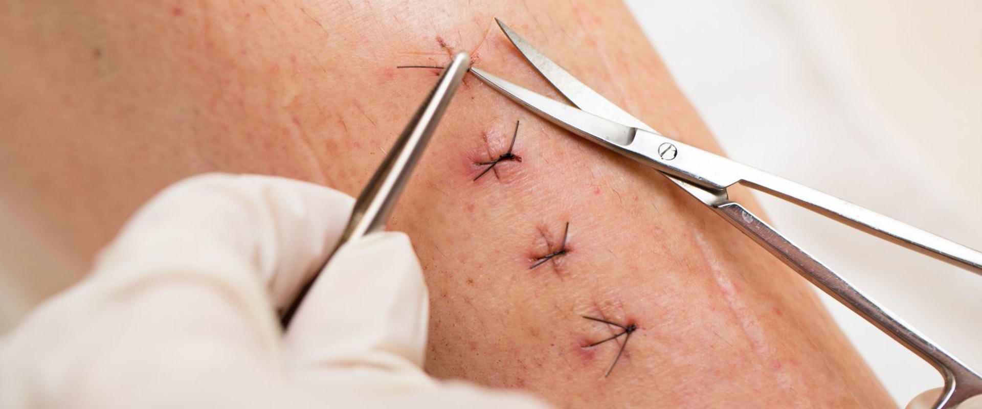 The Best Ways to Monitor Normal Stitches Healing Stages for Faster Recovery