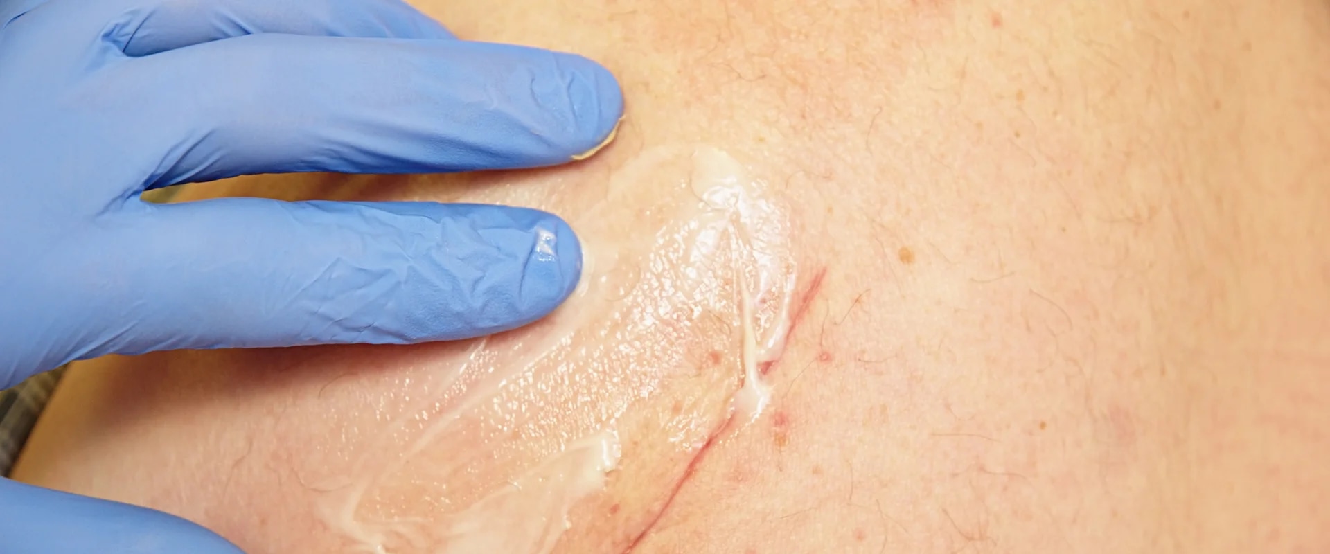 How to Heal Surgery Wounds Faster Using Natural Remedies and Essential ...