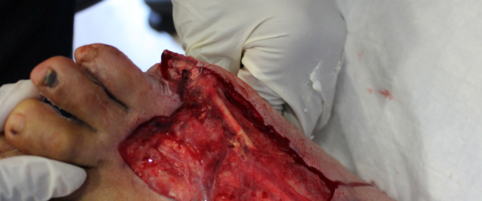 The Importance Of Early Detection In Macerated Skin Wound Treatment