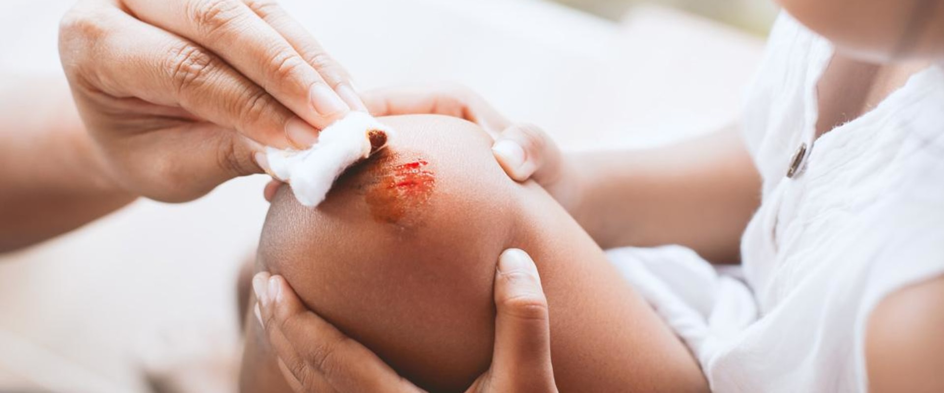 How To Properly Assess And Manage Denuded Skin Wounds