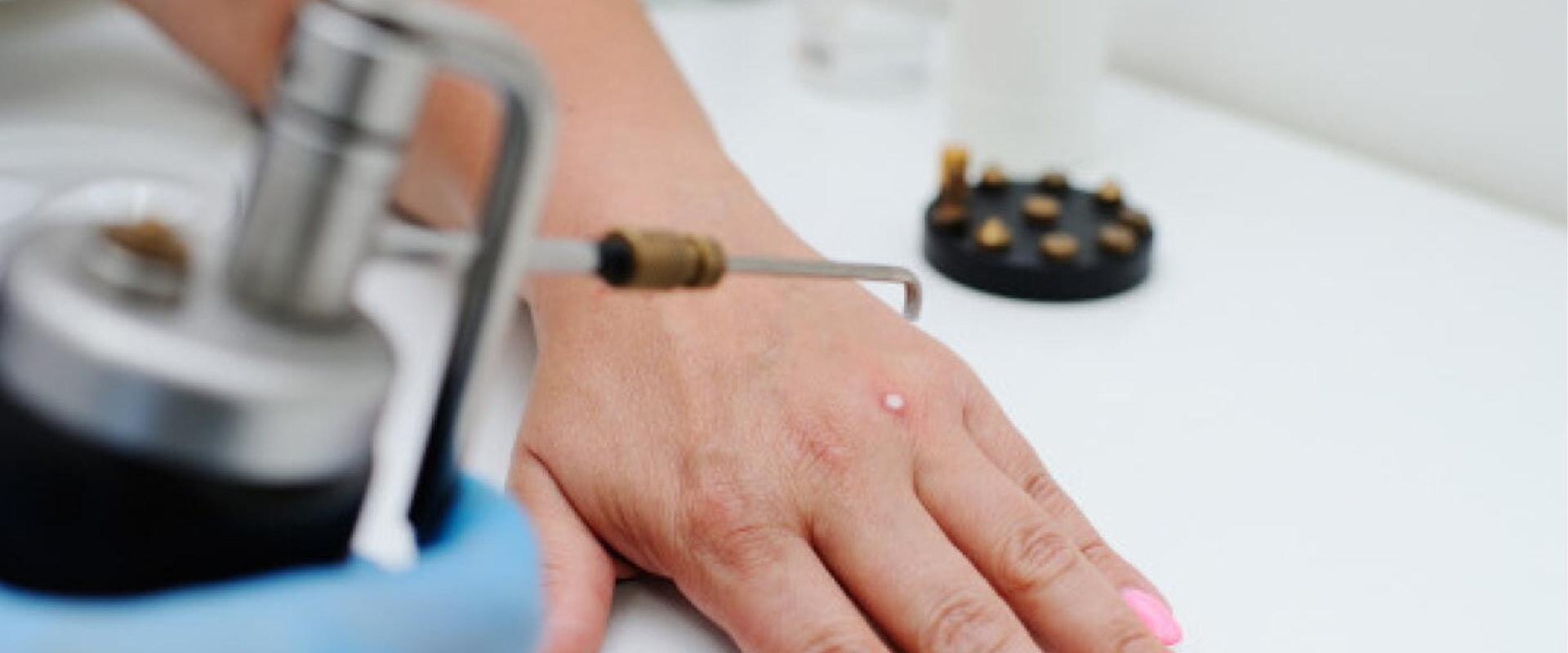 A Practical Guide to Managing Burn Blister Healing Stages at Home